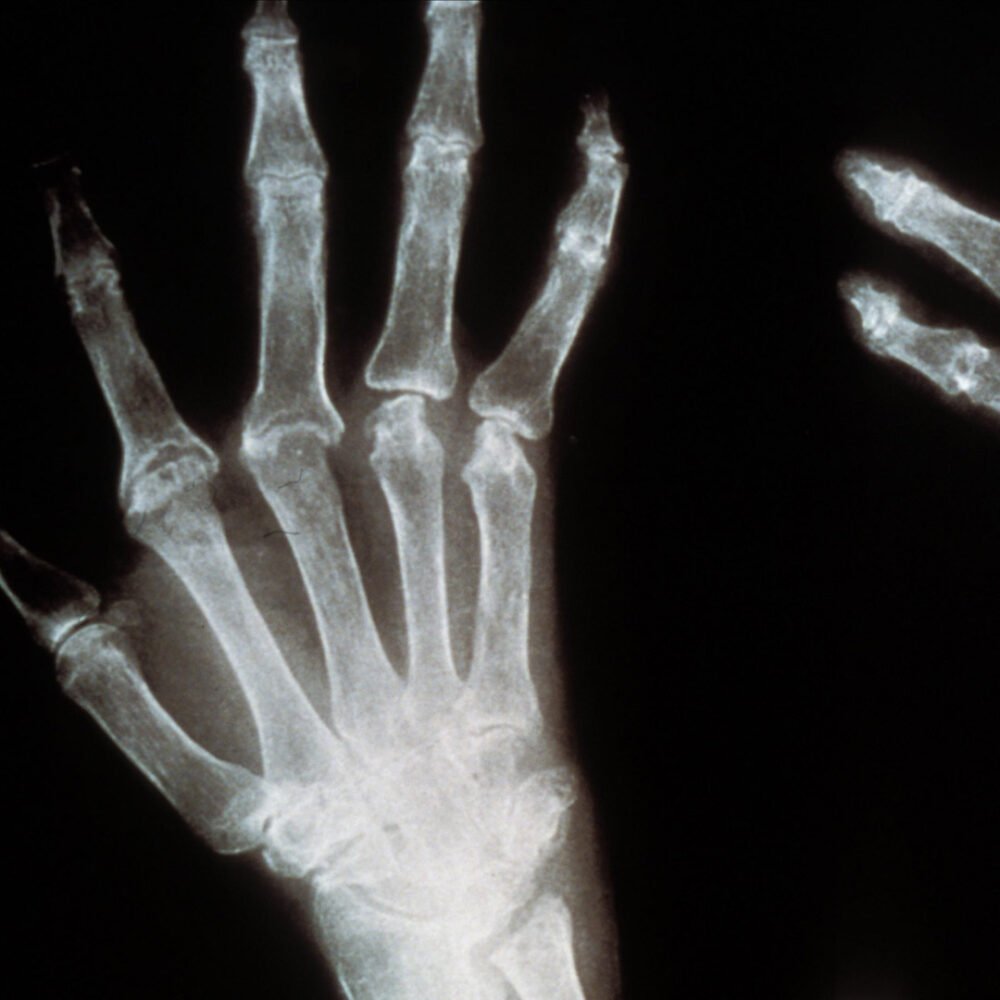 Vitamine D : un traitement contre la polyarthrite rhumatoïde